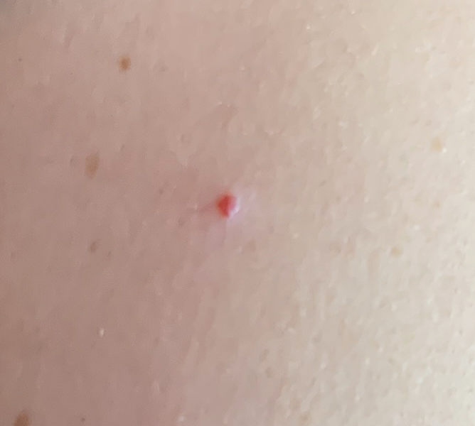 Blood Spot Removal - Advanced Electrolysis Chichester