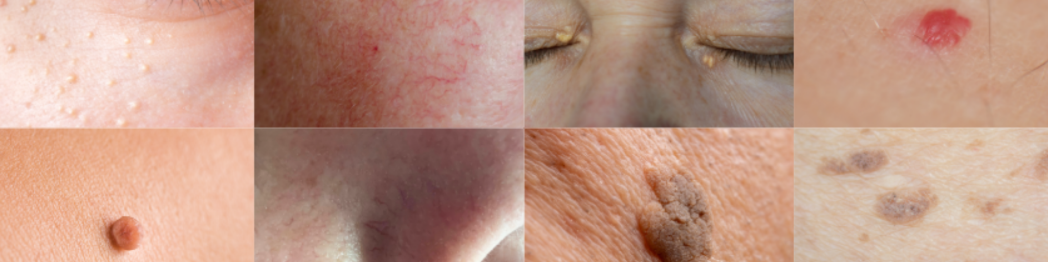 Skin Blemish Removal Advanced Electrolysis